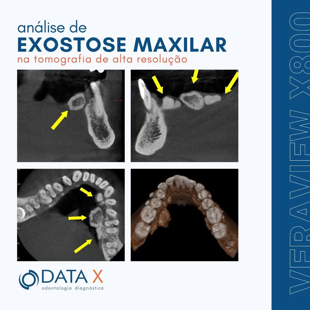 Análise de Exostose Maxilar – DATA X