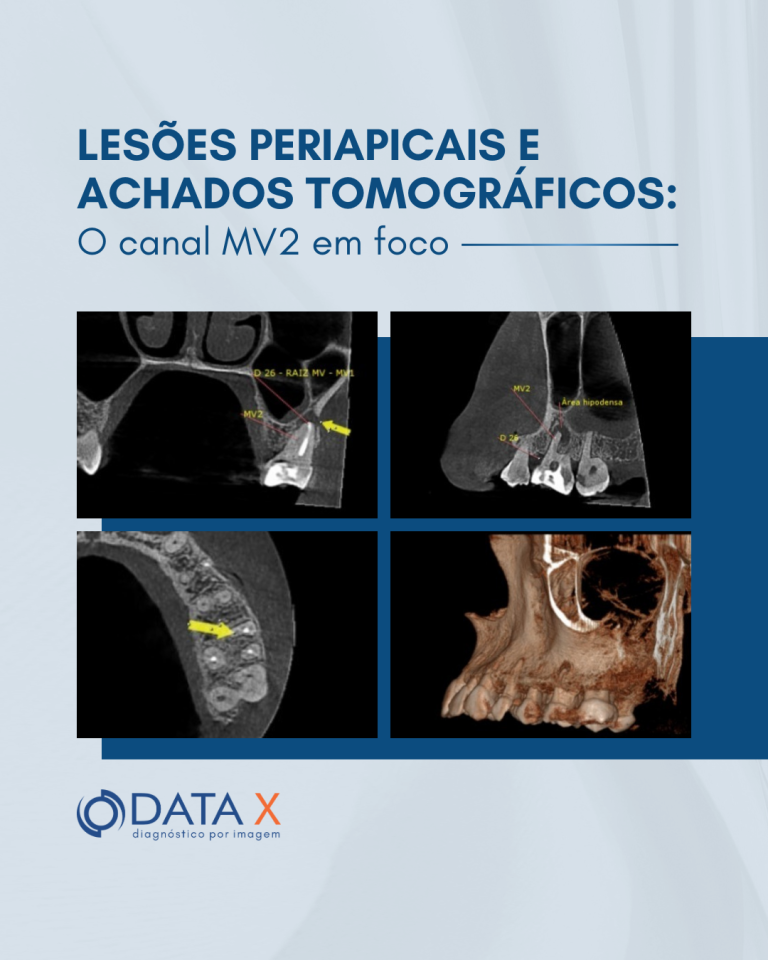 Lesões Periapicais e Achados Tomográficos – DATA X
